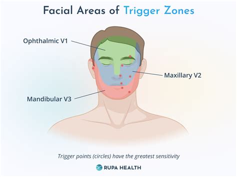 Trigeminal Neuralgia Trigger Points