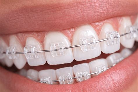 Top Rated Clear Ceramic Braces Bronx Ny Schimmel Orthodontics