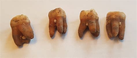 Viking Teeth Show Signs Of Complex Medieval Dentistry