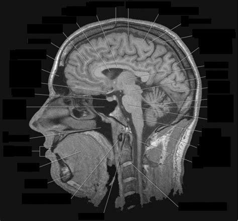 Sagittal Brain Mri Diagram Quizlet