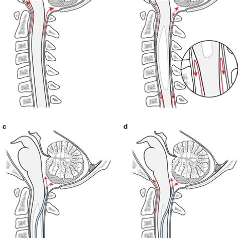 A Normal Cerebrospinal Fluid CSF Flow In The Spinal Canal B In Case Download Scientific