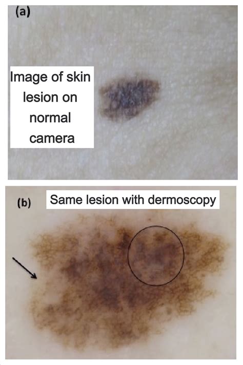 Dermoscopy At Keep On Your Feet Podiatry In Swansea