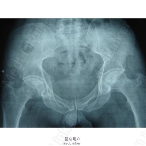 股骨头坏死治疗病例 医联