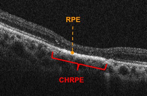 A Complete List Of Ocular Diseases With Optical Coherence Tomography Oct