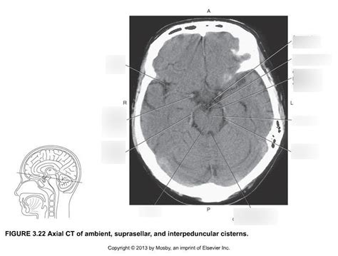 Suprasellar Cistern Anatomy Brain Cisterns Suresh Bishokarma Mch