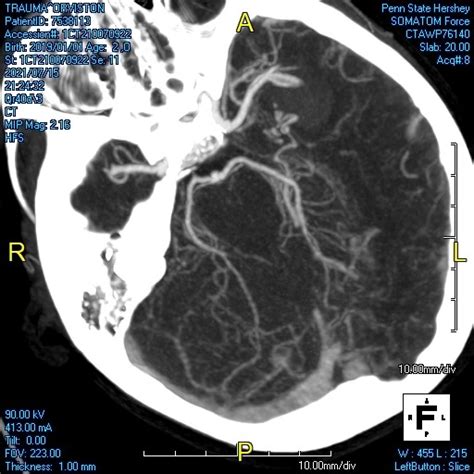 Comprehensive Cerebrovascular Imaging Aans