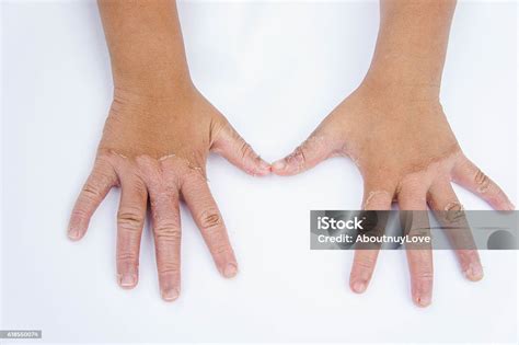 Dry Hands Peel Contact Dermatitis Fungal Infections Skin Inf Stock