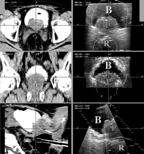 Rectal Dose Sparing With A Balloon Catheter And Ultrasound Localization In Conformal Radiation