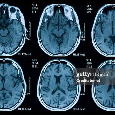 Brain Tumor Mri Classification Dataset 2025 Kaggle