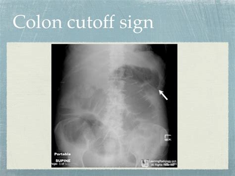 Sentinel Loop Sign X Ray At Charles Gilley Blog