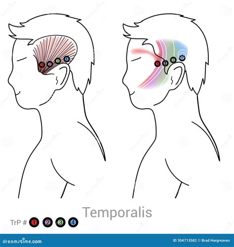 Temporalis Managing Headache Pain Arriving From Myofascial Trigger