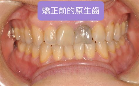 請益門牙做過根管其中一顆變黑了 想做全口美白之後再套上牙冠 但擔心之後其它顆正常的牙齒退色之後會和上排正門牙兩顆的牙套顏色有落差 牙齒矯正