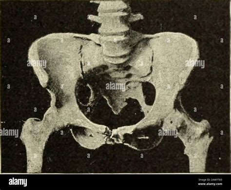 A Textbook Of Obstetrics Ocal Ized Necroses Of The Softtissues Following Labor Inthe