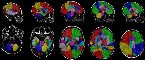 Figure 1 From Automatic Whole Brain Mri Segmentation Of The Developing
