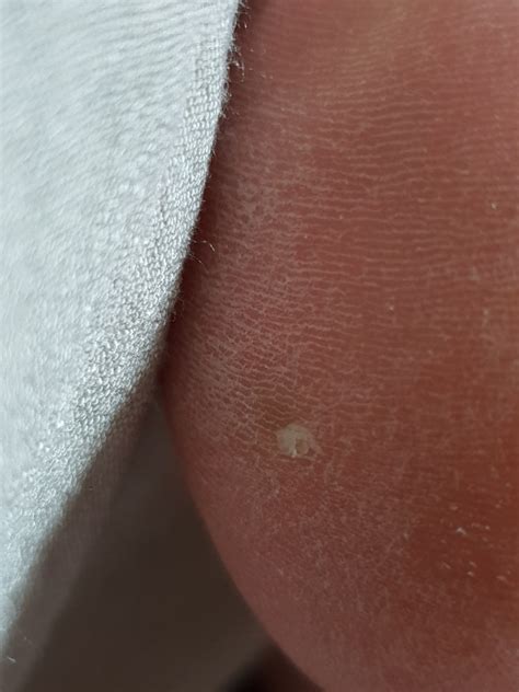 며칠전부터 발바닥 흰 부분을 만지면 지식in