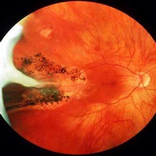 Pdf Toxocariasis A Review