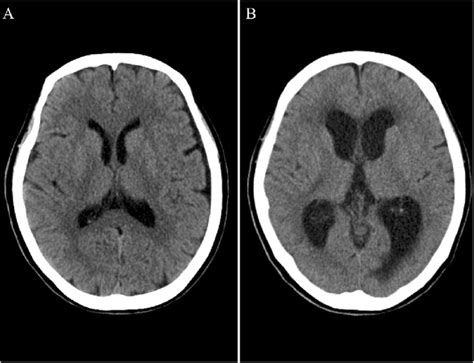 Preoperative And Postoperative Axial Computed Tomography Ct Images