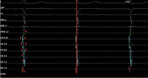 Electrogram Interpretation 11 Ep Essentials