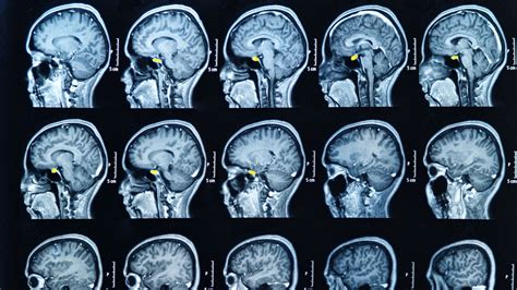 The Hpa Axis Stress Response Involvement In Long Covid And Mecfs