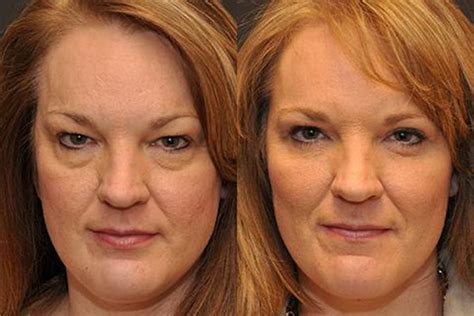 Blepharoplasty Cincinnati Eyelid Surgery Dayton Eyelid Lift Procedure