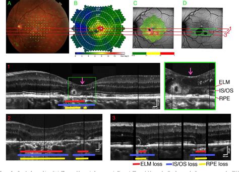 Figure 1 From Multimodal Assessment Of Microscopic Morphology And Retinal Function In Patients