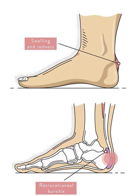 Heel Pain Causes Types And Podiatry Treatment