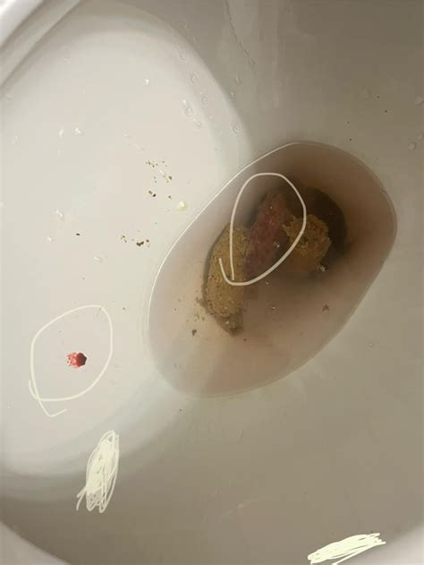 Could This Is From Hemorrhoids Rpoop