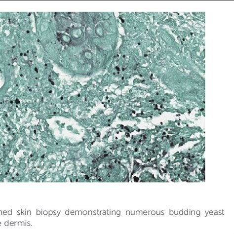 Pas Stained Rectal Biopsy Showing Abundant Histiocytes Within The Download Scientific Diagram