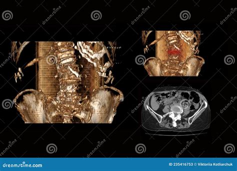Computed Tomography Of The Spine With A Fracture Of The Vertebrae And Their Displacement From A