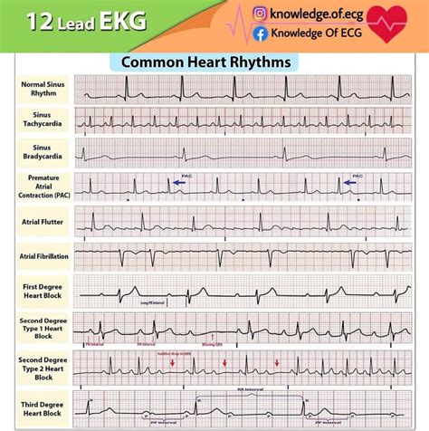 Did You Know The Common Heart Rhythms😌 Knowledge Of Ecg Facebook