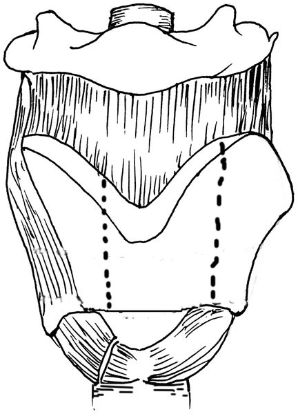 Partial Laryngectomy