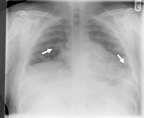 What Chest X Ray Shows At Jose Caceres Blog