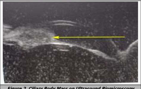 Figure 2 From A Rare Case Of Ciliary Body Melanoma Masquerading As Secondary Angle Closure