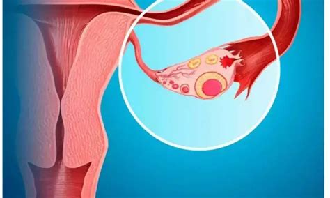 Use Of Preoperative Algorithm May Prevent Unnecessary Oophorectomy