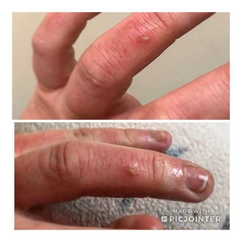 Digital Ulcer Hello Lovely People Scleroderma And Ray