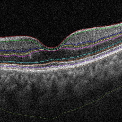 Example Slices From The Oct Volumes Of Diseased Eyes The Left Column