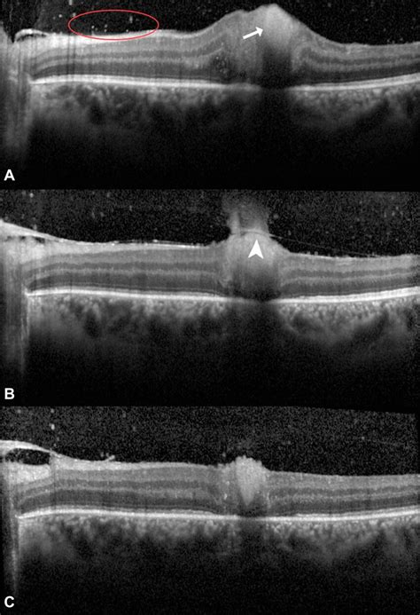 Lesion Images In A 51 Year Old Male Patient With Complicated Download Scientific Diagram