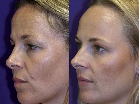 Botox Effects What Happened When Only One Twin Got Treated Faculty Of Medicine