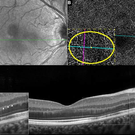 Acute Macular Neuroretinopathy Amn Pattern 1 Convergence Of Deep
