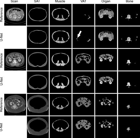 Automated Abdominal Segmentation Of Ct Scans For Body Composition Analysis Using Deep Learning