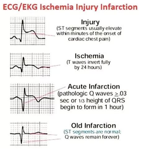 Ecg In Ischemic Injury Seems Like This Rmedizzy