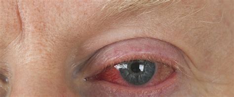 Does Being Tired Affect Eye Tests