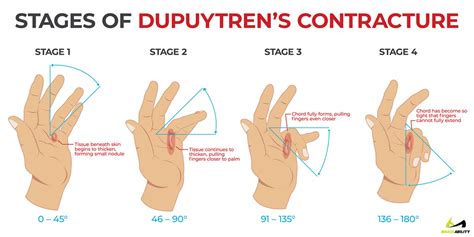 Are There Exercises For Dupuytrens Contracture At Donald Gaillard Blog