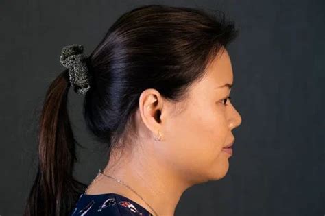 Resound Omnia 5 Ric At 249995 Hearing Instrument In Surat ID 2849542163197