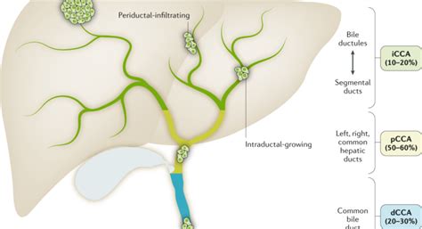 Cholangiocarcinoma Bile Duct Cancer Diagnosis And Treatment