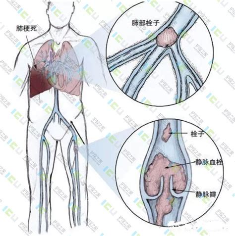 深静脉血栓股青肿图片 股白肿图片 大山谷图库