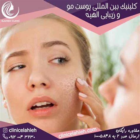 انواع لکه های سفید پوستی چیست؟ کلینیک بین المللی پوست مو و زیبایی الهیه