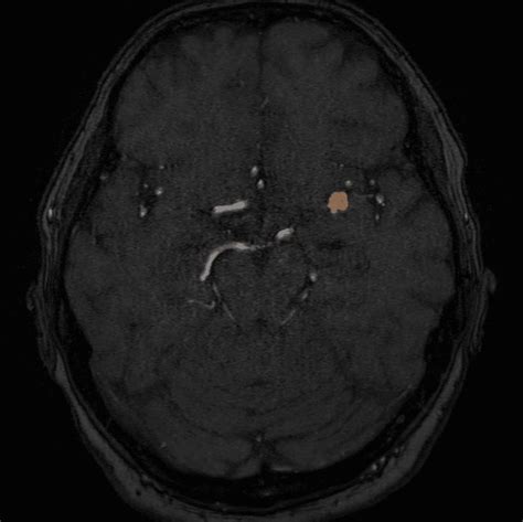 Automated Lesion Characterization