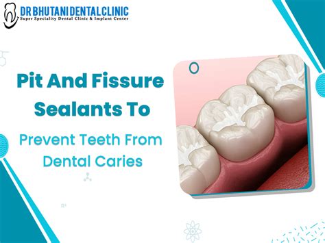 Application Of Fissure Sealants At Judy Parks Blog