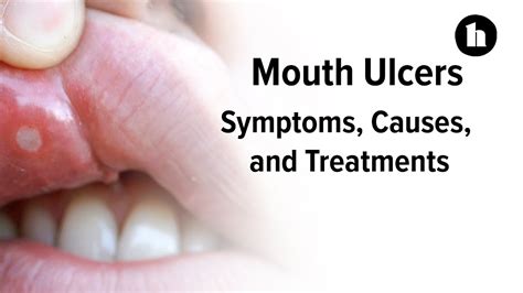 Mouth Ulcers Symptoms Diagnosis And Treatments Healthline Youtube